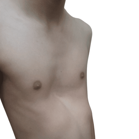 ¿Qué es el Pectus Excavatum? La Guía que Todo Padre Necesita Dr. Carlos ...